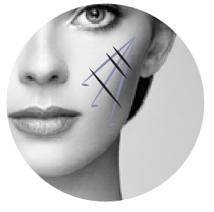 PDO Threads: 3 Vector Cheek | Zero Gravity Aesthetics and Wellness