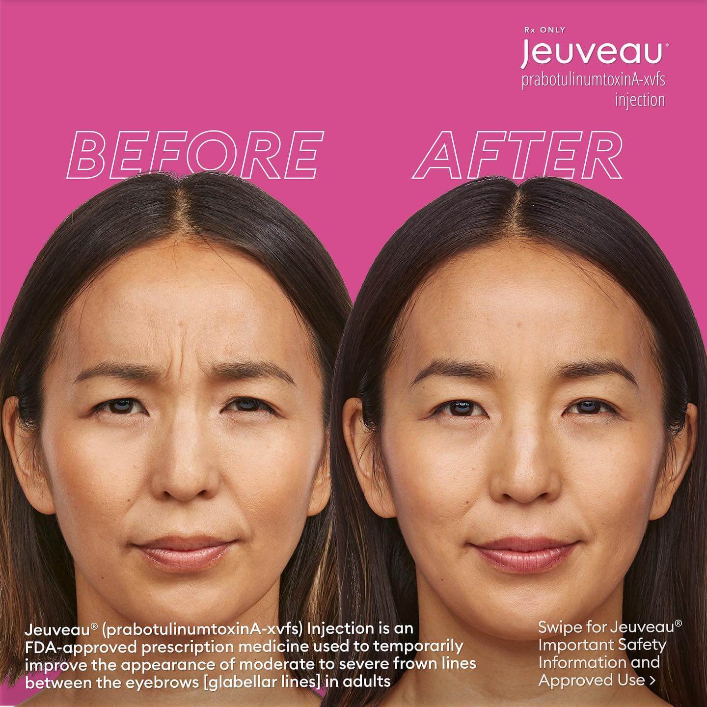 Jeuveau® | Zero Gravity Aesthetics and Wellness