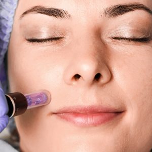 Microneedling Treatments | Zero Gravity Med Spa NKY
